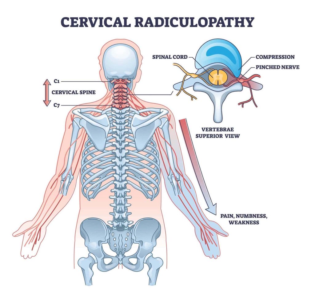 Cervical Radiculopathy Treatment Singapore - Oxford Spine & Neuro