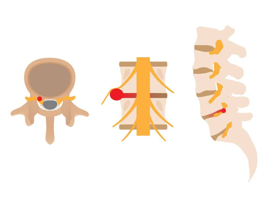 Sciatica Treatment Singapore | Pinched Nerve Pain Treatment - Oxford ...