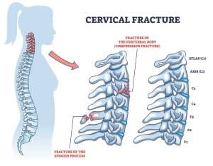 Cervical Myelopathy | Oxford Spine & Neuro Singapore