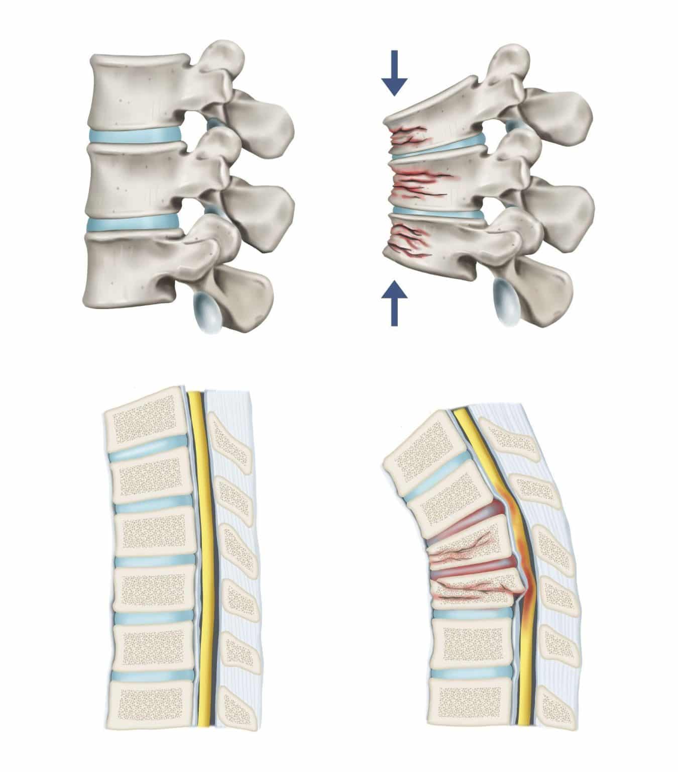 Spinal Fractures Treatment Singapore - Oxford Spine & Neuro