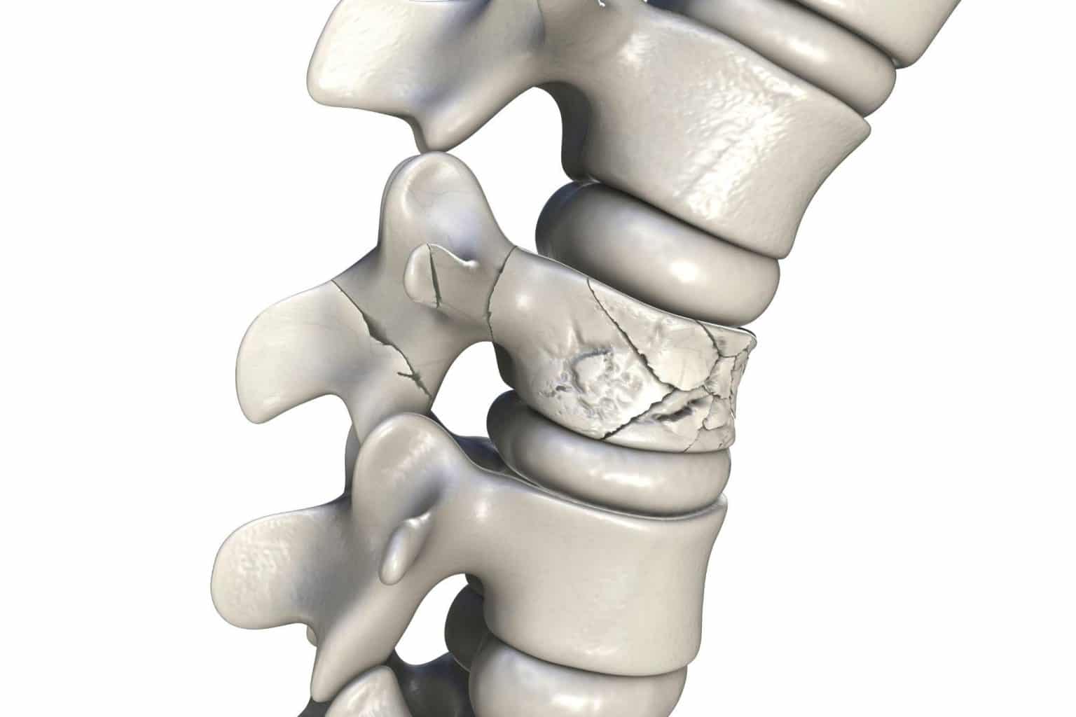 Spinal Fractures - Oxford Spine & Neuro