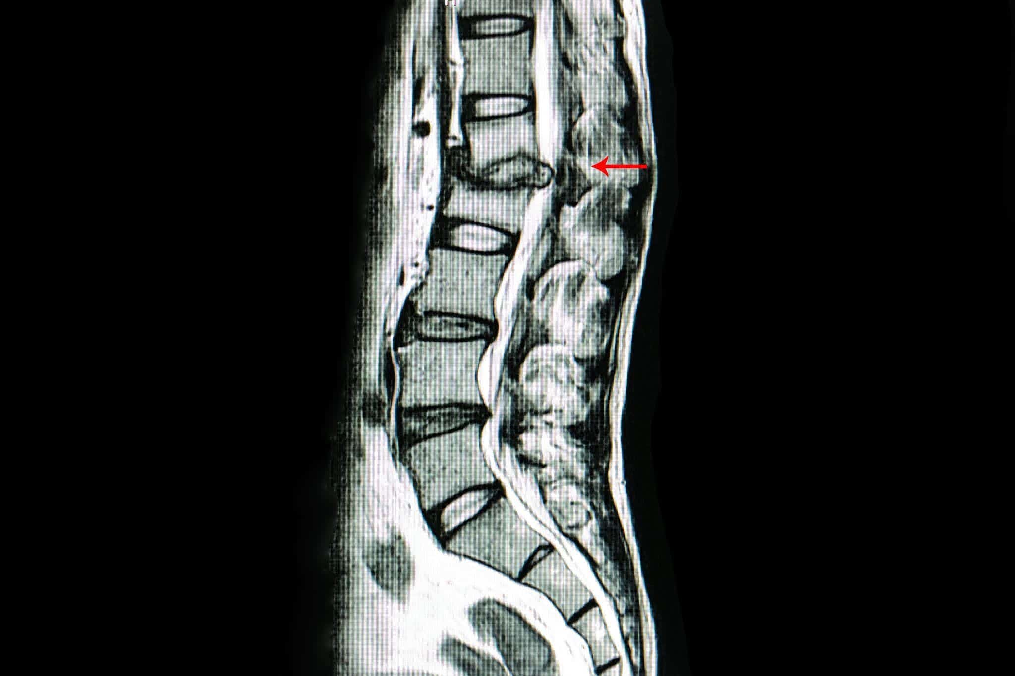 Spinal Infections - Oxford Spine & Neuro