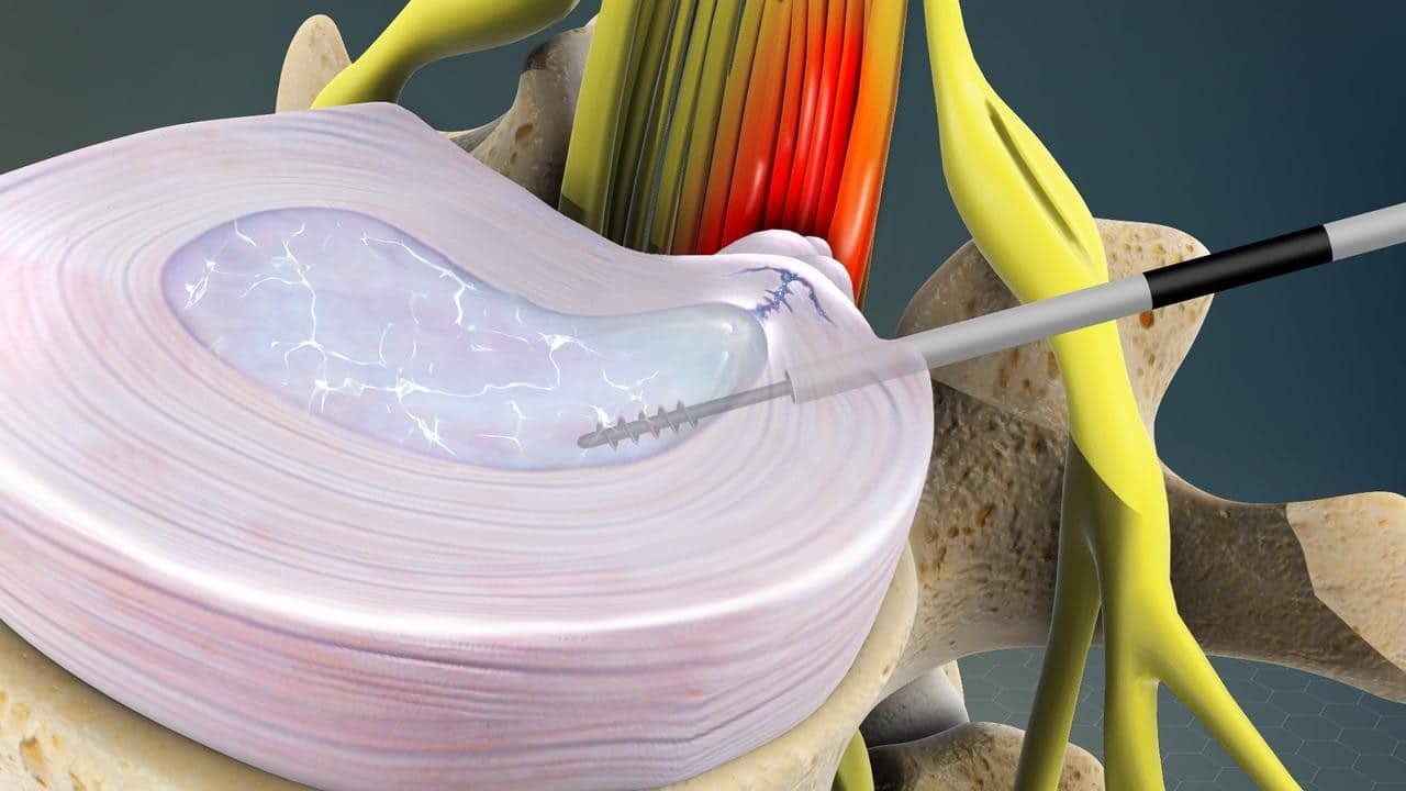 Nucleoplasty for Disc-related Pain | Oxford Spine & Neuro
